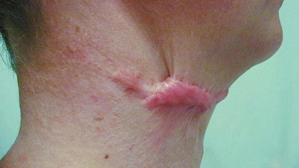 Narbenbehandlungen und Korrektureingriffe in der Praxis - Plastische ...