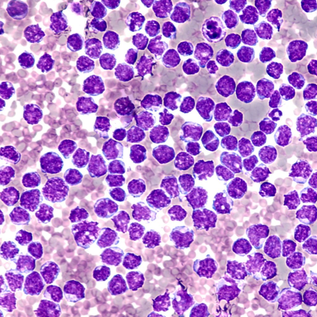 Relevante Verbesserung der Effektivität durch Acalabrutinib ...