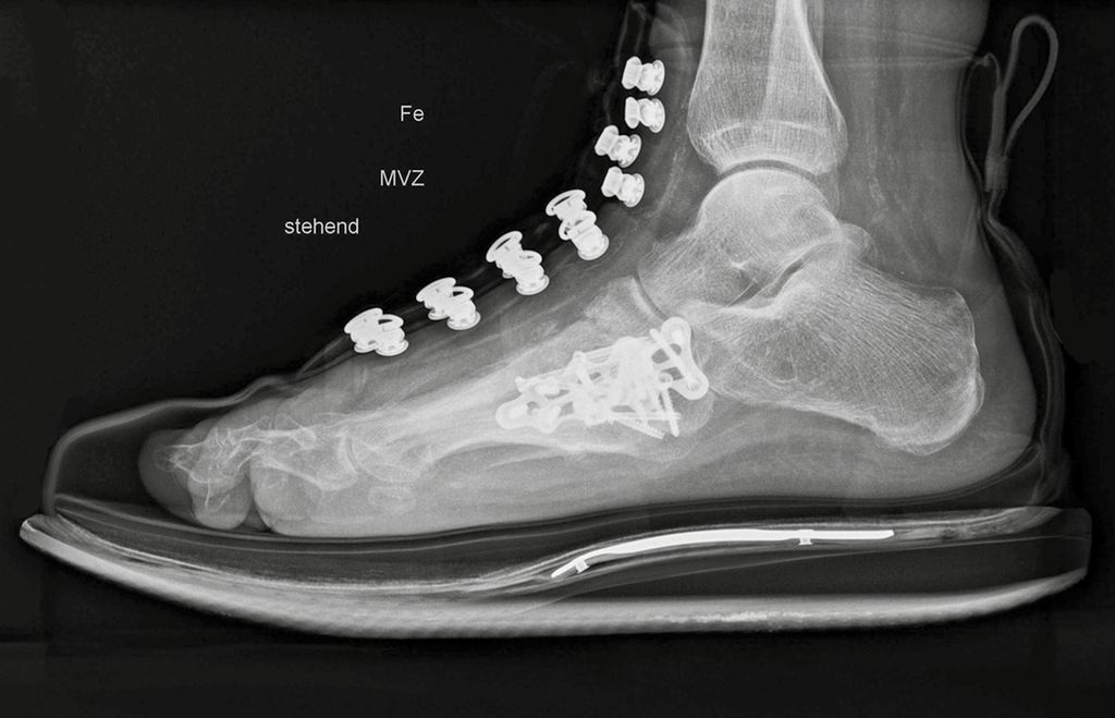 Optionen der inneren Fixation bei Charcot-Arthropathie - Orthopädie ...